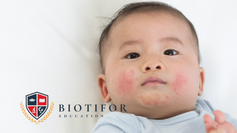 Biang Keringat pada Bayi: Gejala, Penyebab, dan Cara Mengatasi - Biotifor