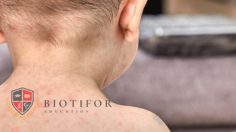 Biang Keringat pada Bayi: Gejala, Penyebab, dan Cara Mengatasi - Biotifor