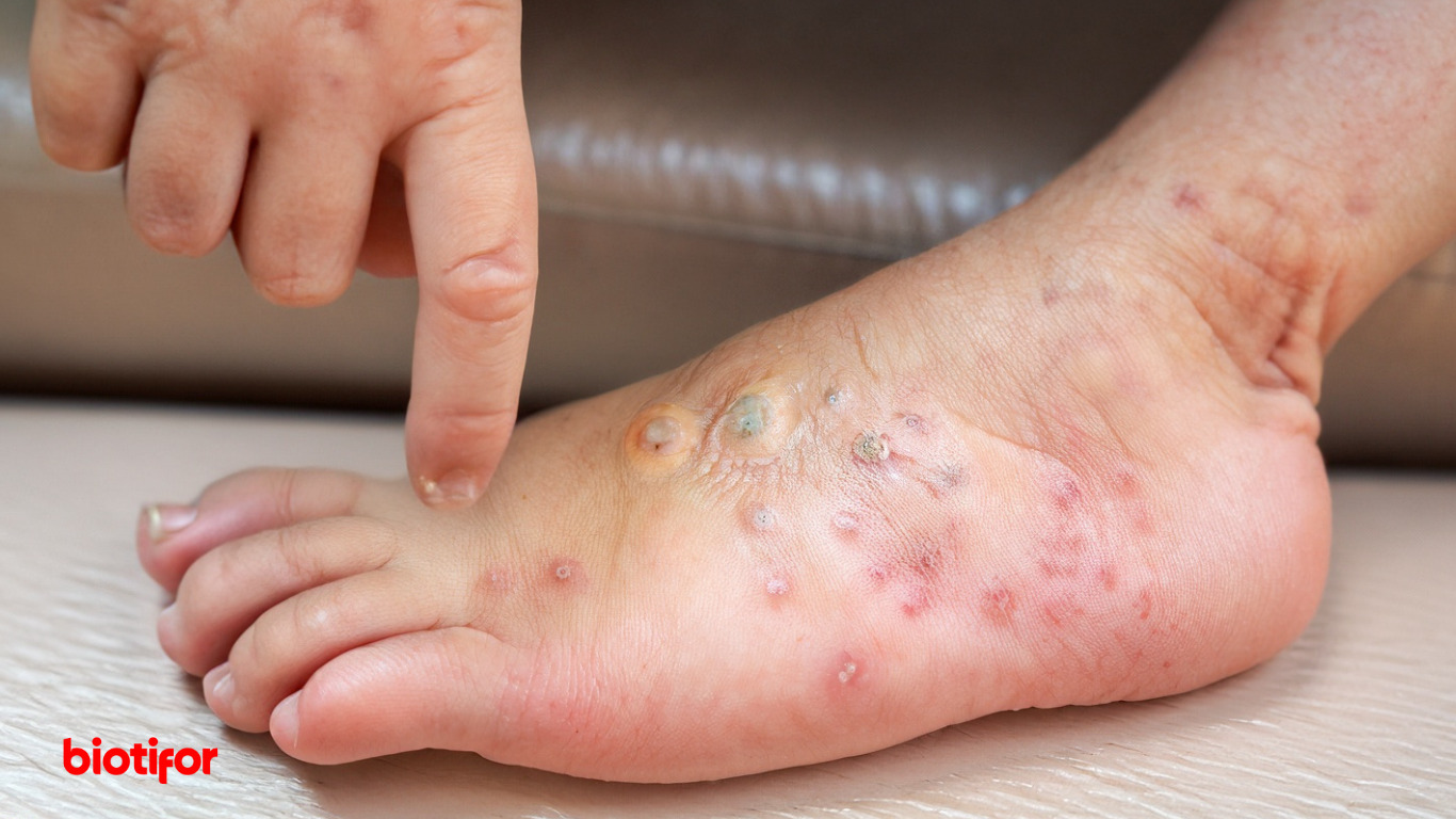 Mata Ikan di Kaki: Penyebab, Pengobatan, dan Pencegahan - Biotifor
