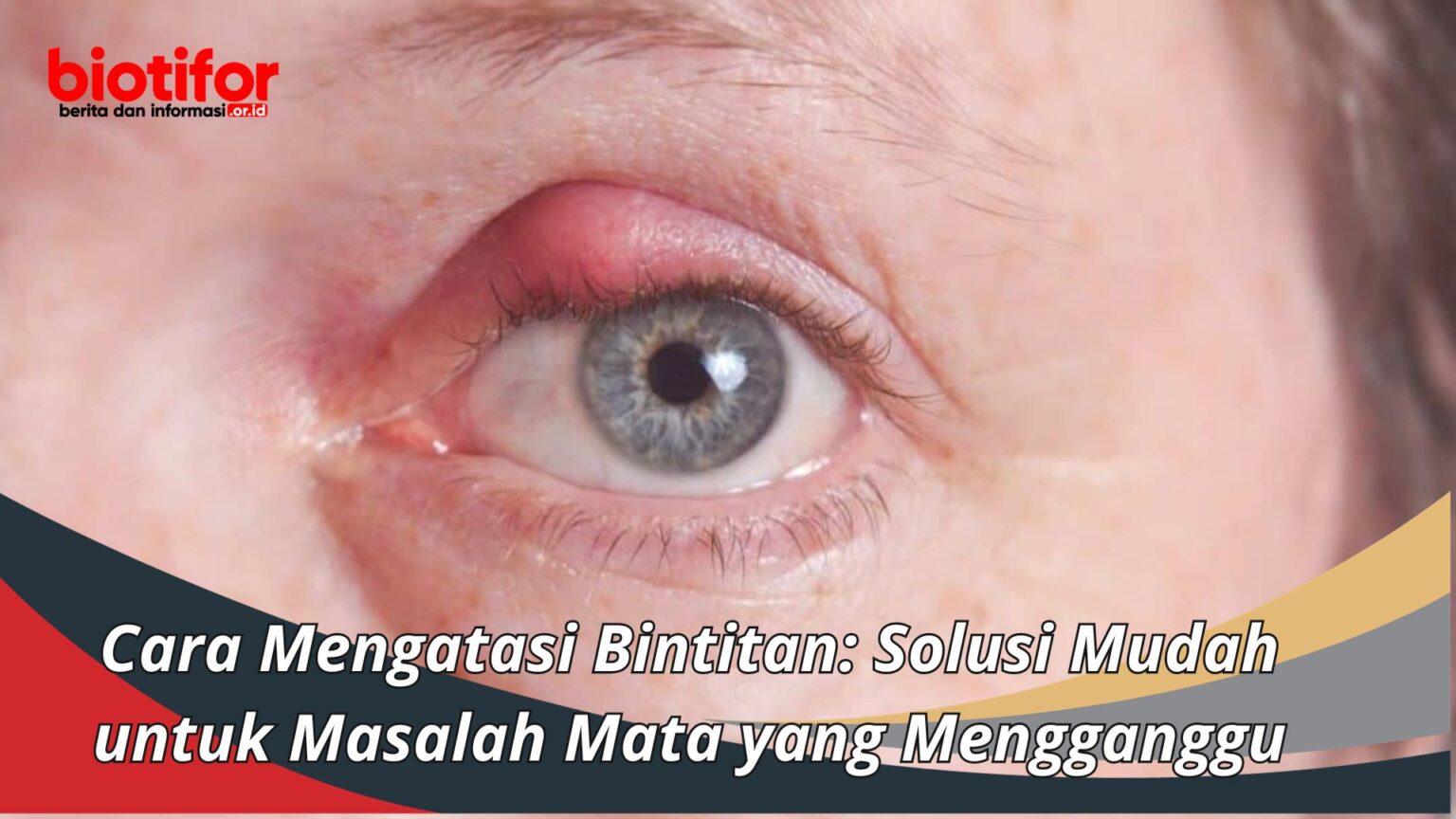 Cara Mengatasi Bintitan: Solusi Mudah untuk Masalah Mata yang Mengganggu