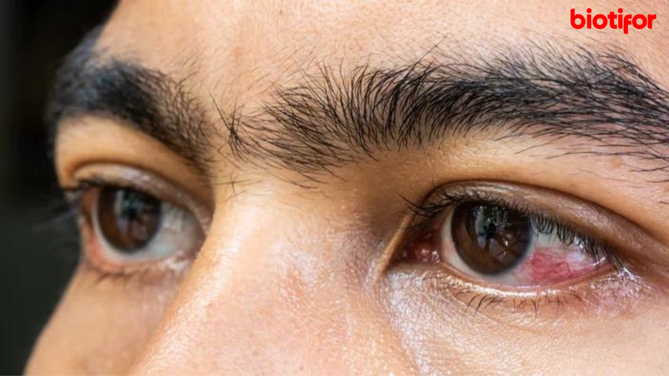Cara Mengatasi Mata Merah dengan Mudah, Simak! - Biotifor