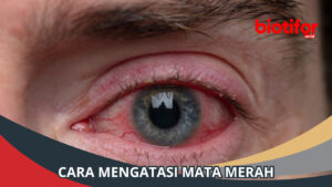Cara Mengatasi Mata Merah dengan Mudah, Simak! - Biotifor