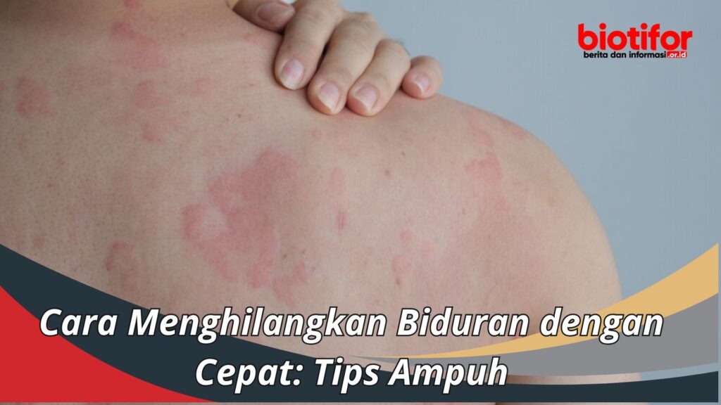 Cara Menghilangkan Biduran dengan Cepat: Tips Ampuh
