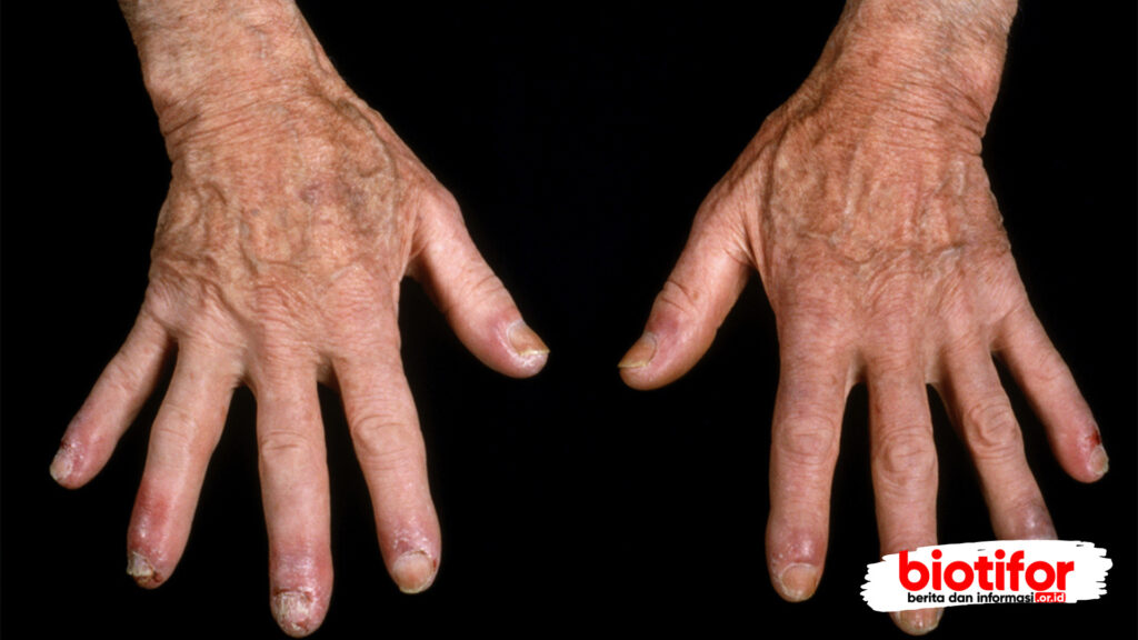 Gejala Penyakit Lupus : Tanda-Tanda Yang Perlu Diwaspadai