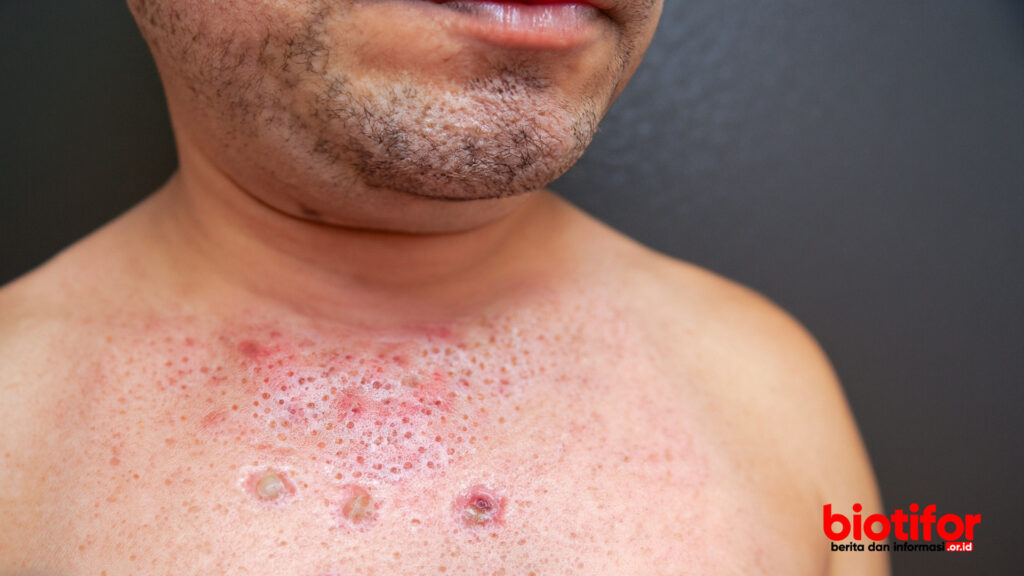 Cara Mengobati Kutil Dengan Efektif Dan Benar