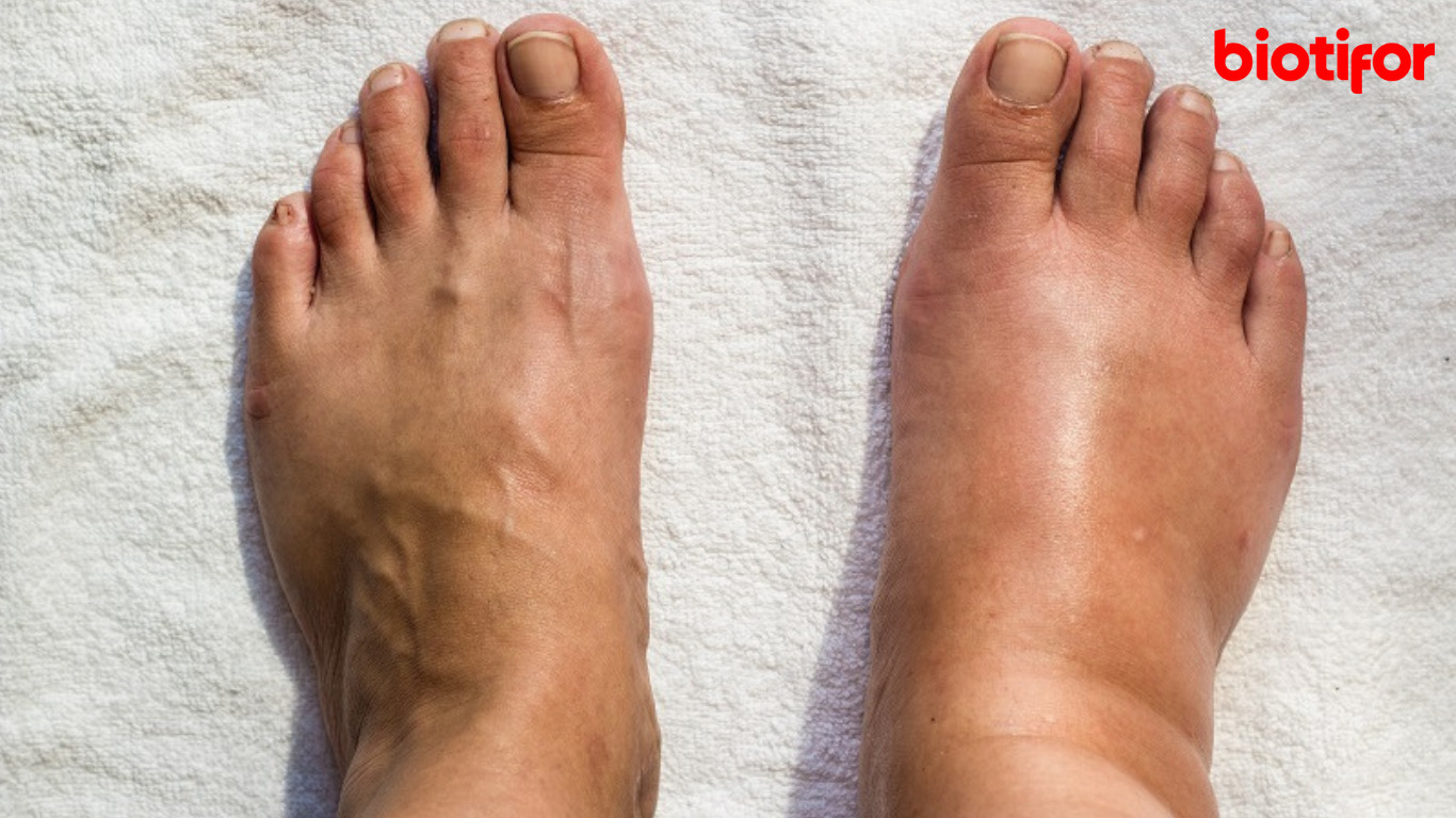 Cara Mengatasi Kaki Bengkak dan Penyebabnya, Simak - Biotifor