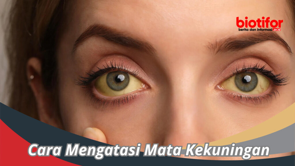 Cara Mengatasi Mata Kekuningan , Jangan Panik! Ini Dia Solusinya - Biotifor