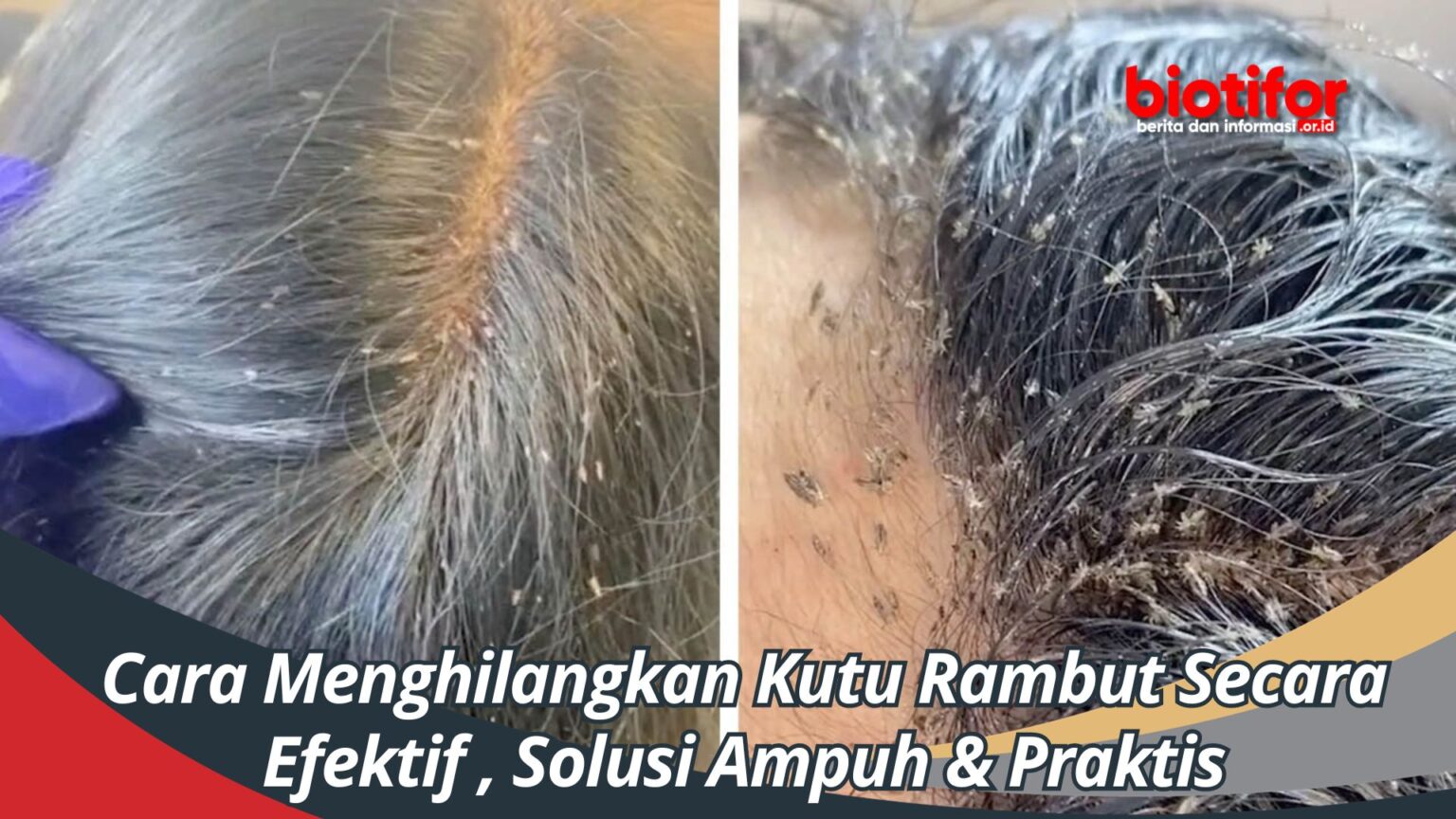 Cara Menghilangkan Kutu Rambut Secara Efektif , Solusi Ampuh & Praktis