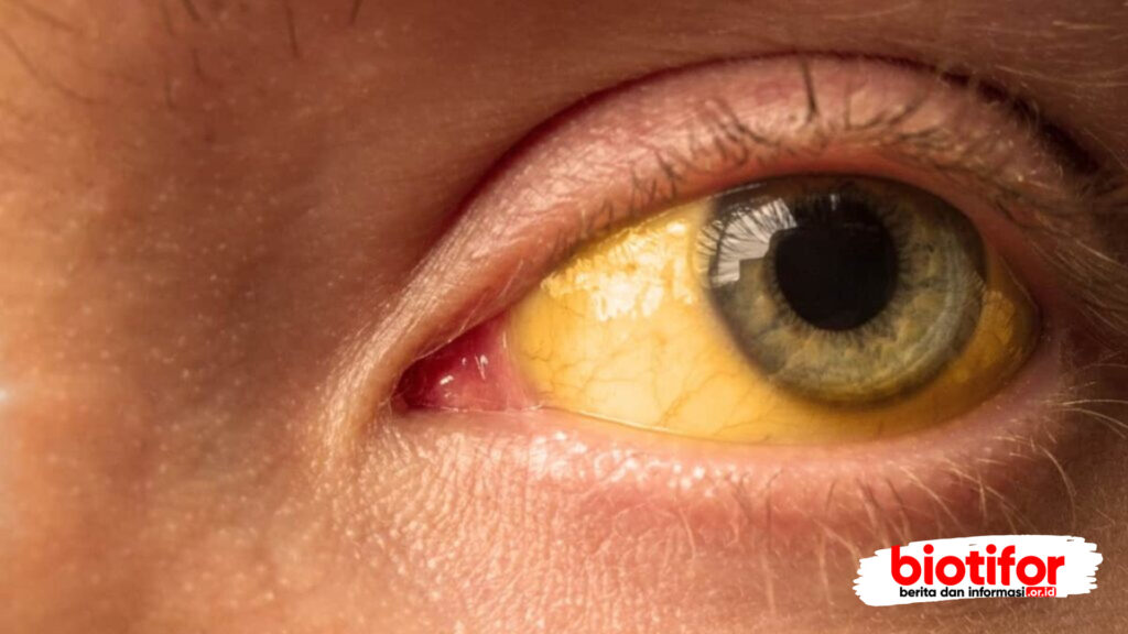 Apa Saja Penyebab Mata Kuning ? Ini Dia Penyebab Utamanya - Biotifor