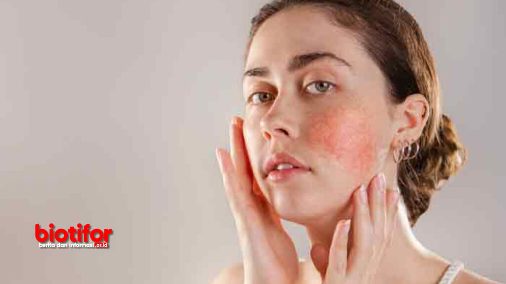 Cara Menghilangkan Muka Merah Akibat Cream Perhatikan Dmpak Dan Cara ...