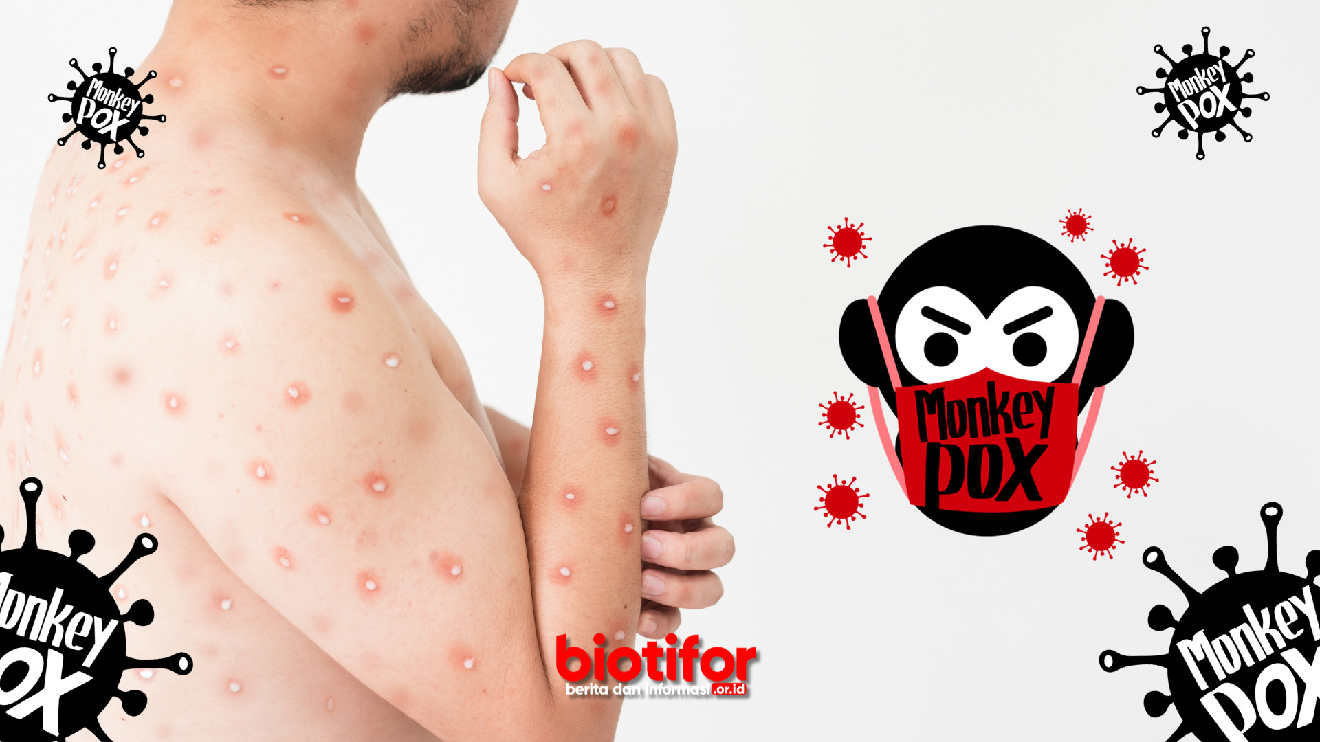 Ketahui 8 Gejala Cacar Monyet yang Harus Diwaspadai! - Biotifor