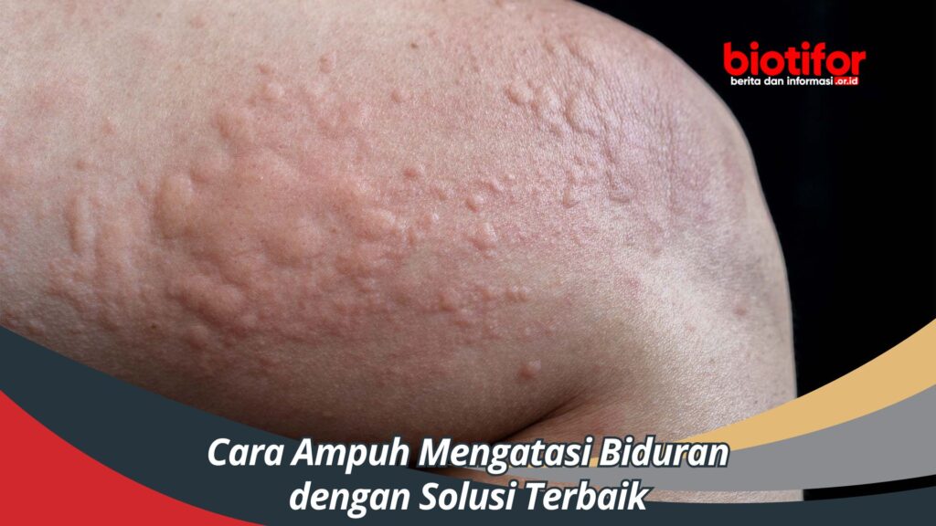 Cara Ampuh Mengatasi Biduran dengan Solusi Terbaik - Biotifor
