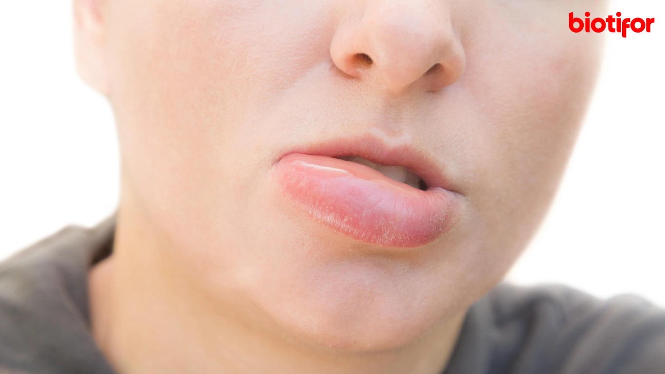 Cara Mengatasi Bibir Bengkak dengan Cepat - Biotifor