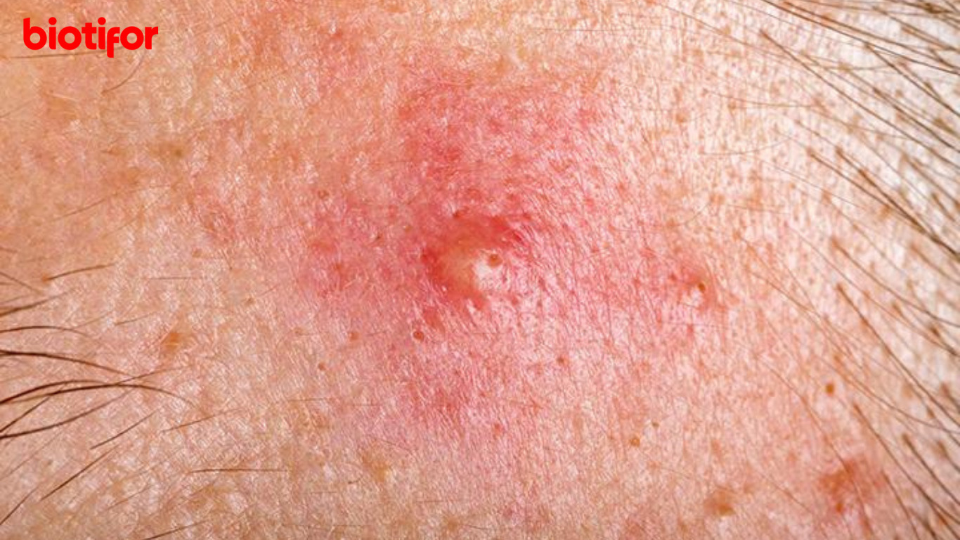 10 Cara Mengatasi Jerawat Nodul - Biotifor
