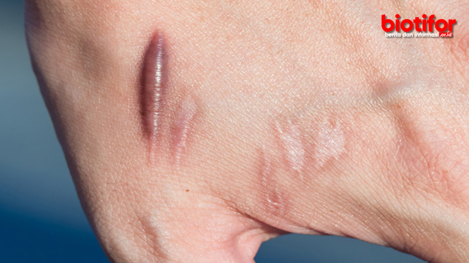 Cara Mengatasi Keloid,Tips Perawatan Kulit - Biotifor