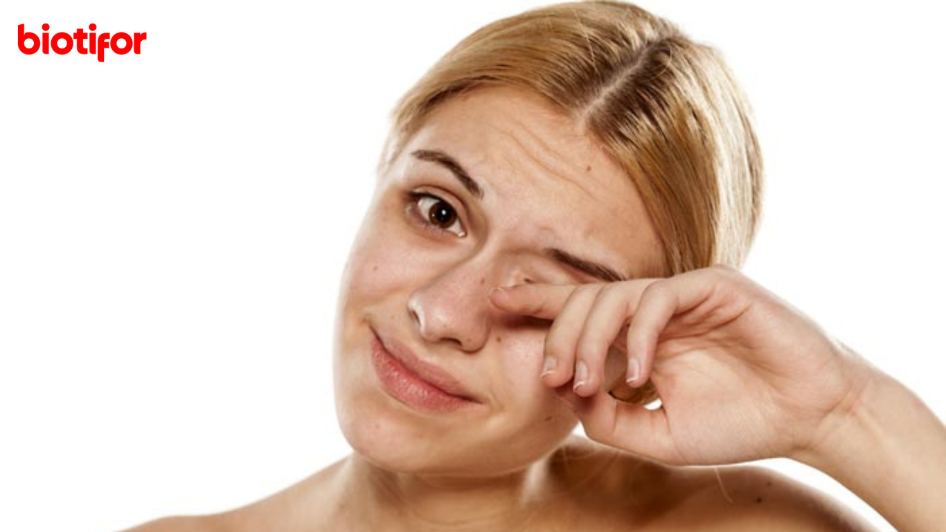 Cara Mengatasi Mata Gatal: Solusi Kesehatan Mata Anda - Biotifor