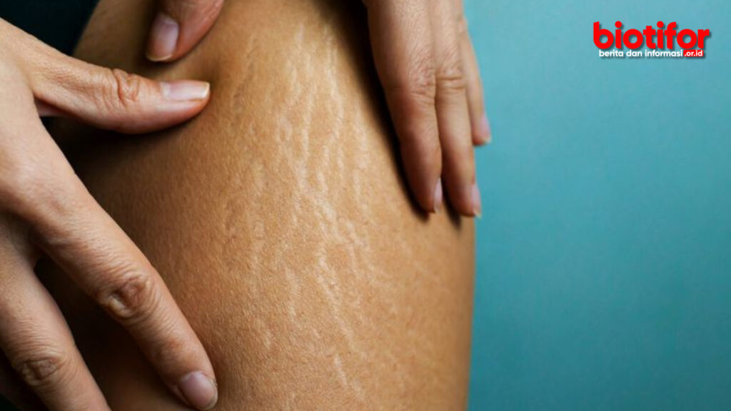 Cara Mengatasi Stretch Mark, Panduan Lengkap - Biotifor