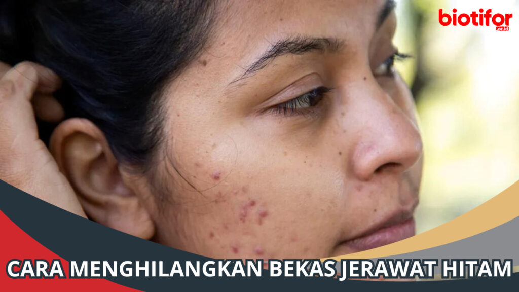 Cara Menghilangkan Bekas Jerawat Hitam, Ternyata Mudah! - Biotifor