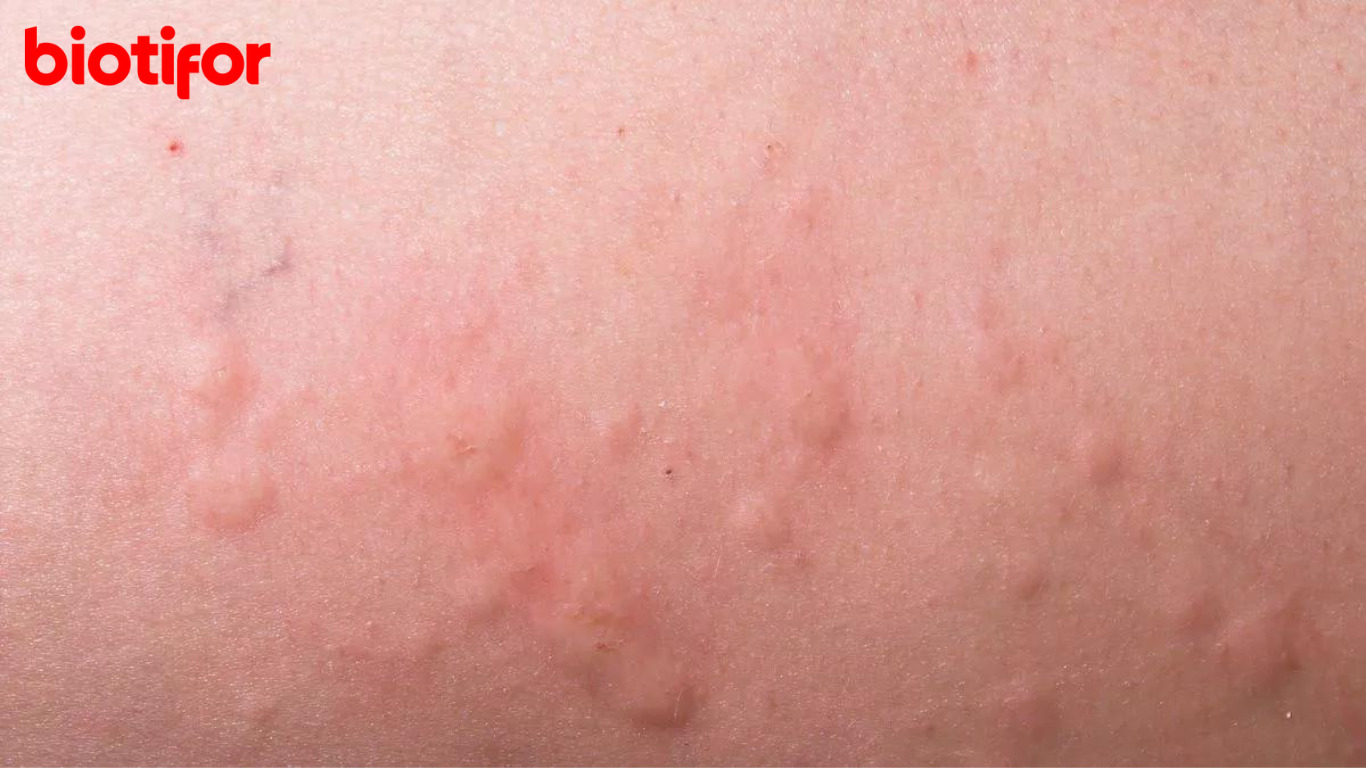 Cara Menghilangkan Kaligata, Mengatasi Gatal-Gatal! - Biotifor