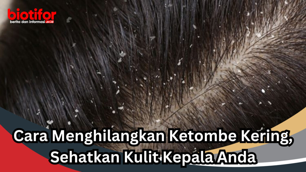 Cara Menghilangkan Ketombe Kering, Sehatkan Kulit Kepala Anda - Biotifor