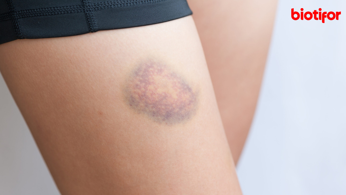 Cara Menghilangkan Memar Biru, Mudah dan Cepat! - Biotifor