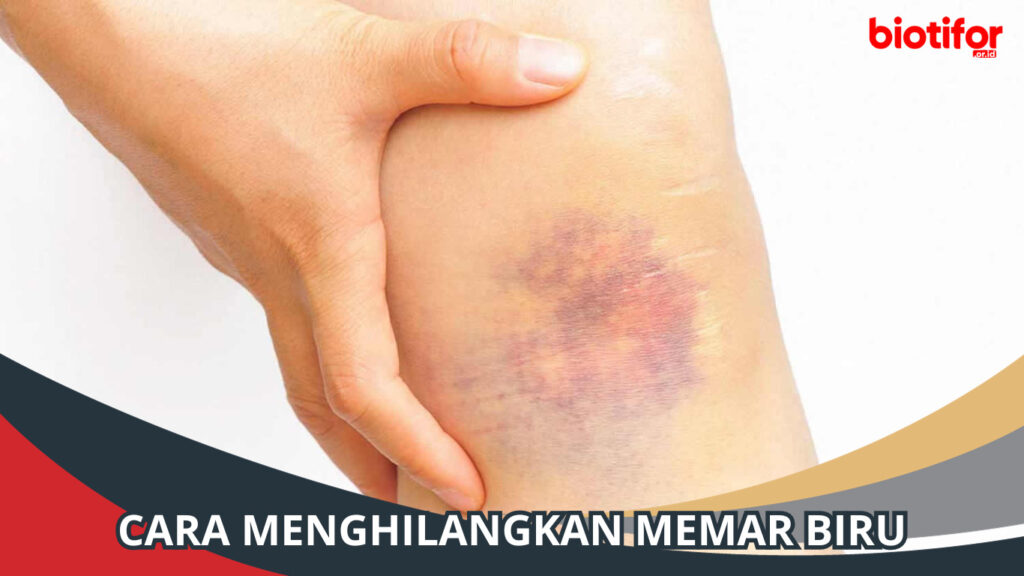 Cara Menghilangkan Memar Biru, Mudah dan Cepat! - Biotifor