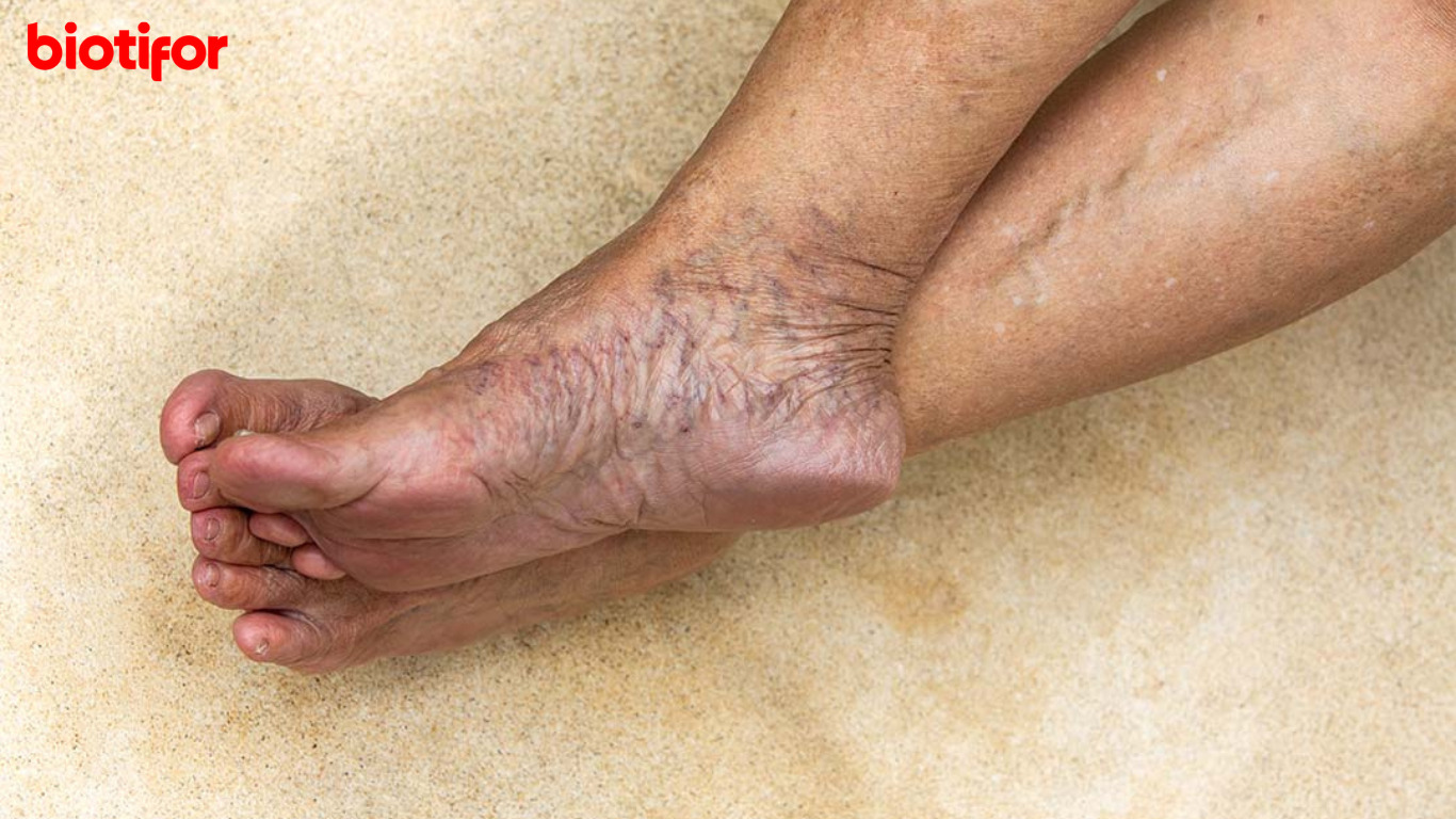 Cara Menghilangkan Varises: Tips dan Trik untuk Kaki Sehat - Biotifor