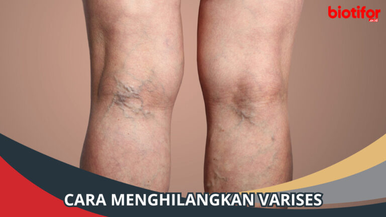 Cara Menghilangkan Varises: Tips dan Trik untuk Kaki Sehat - Biotifor
