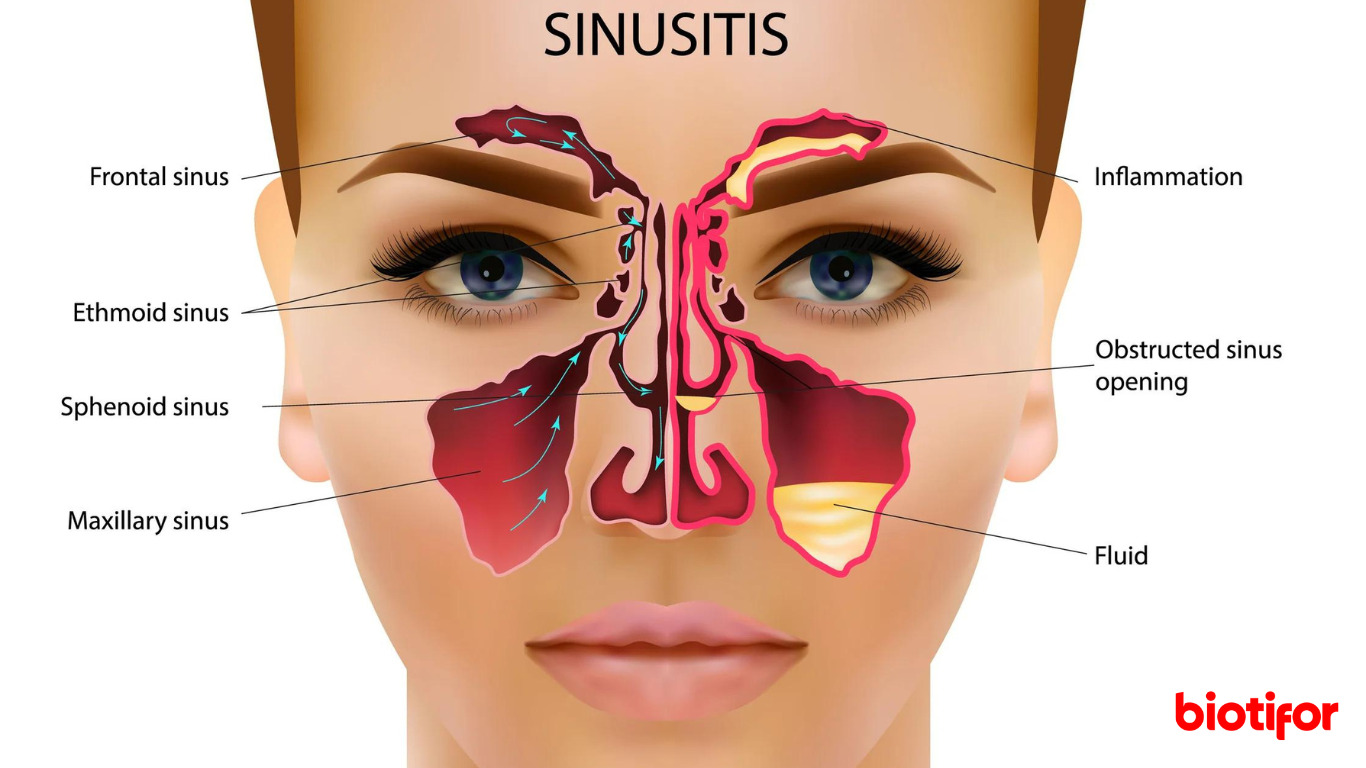 Cara Mengobati Sinusitis dengan Mudah Secara Alami - Biotifor