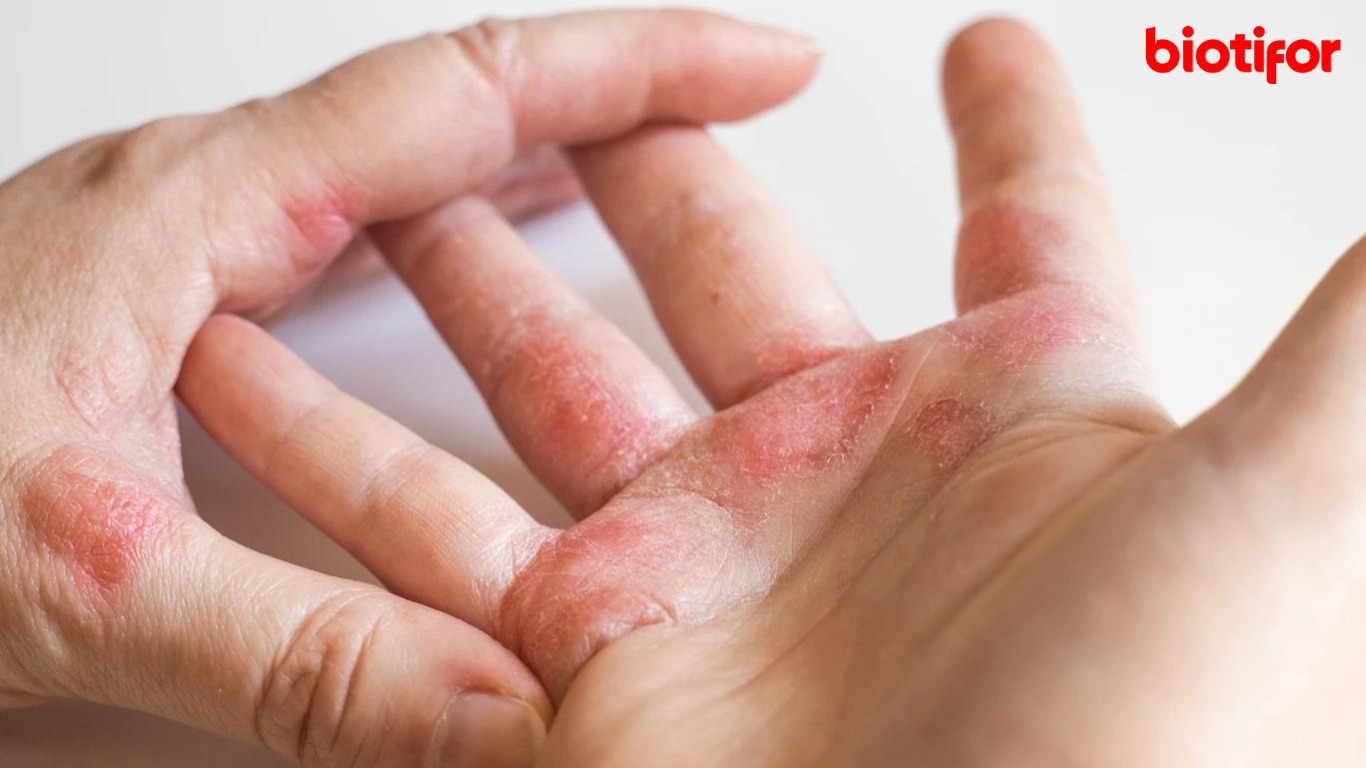 Cara Menyembuhkan Eksim Secara Total - Biotifor