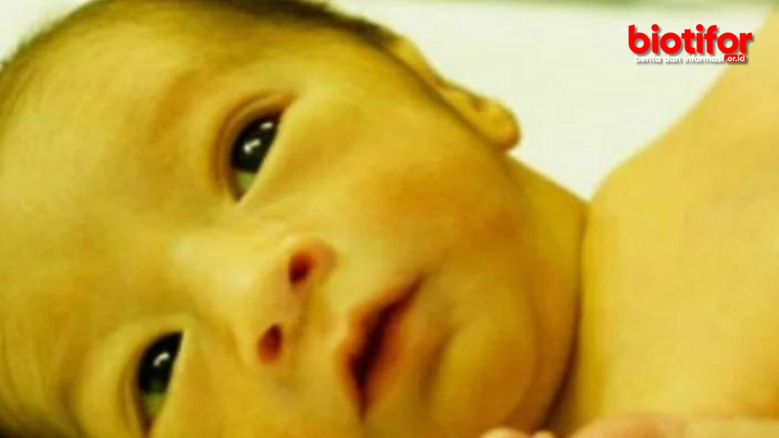 Cara Mengatasi Bayi Kuning, Panduan Lengkap - Biotifor
