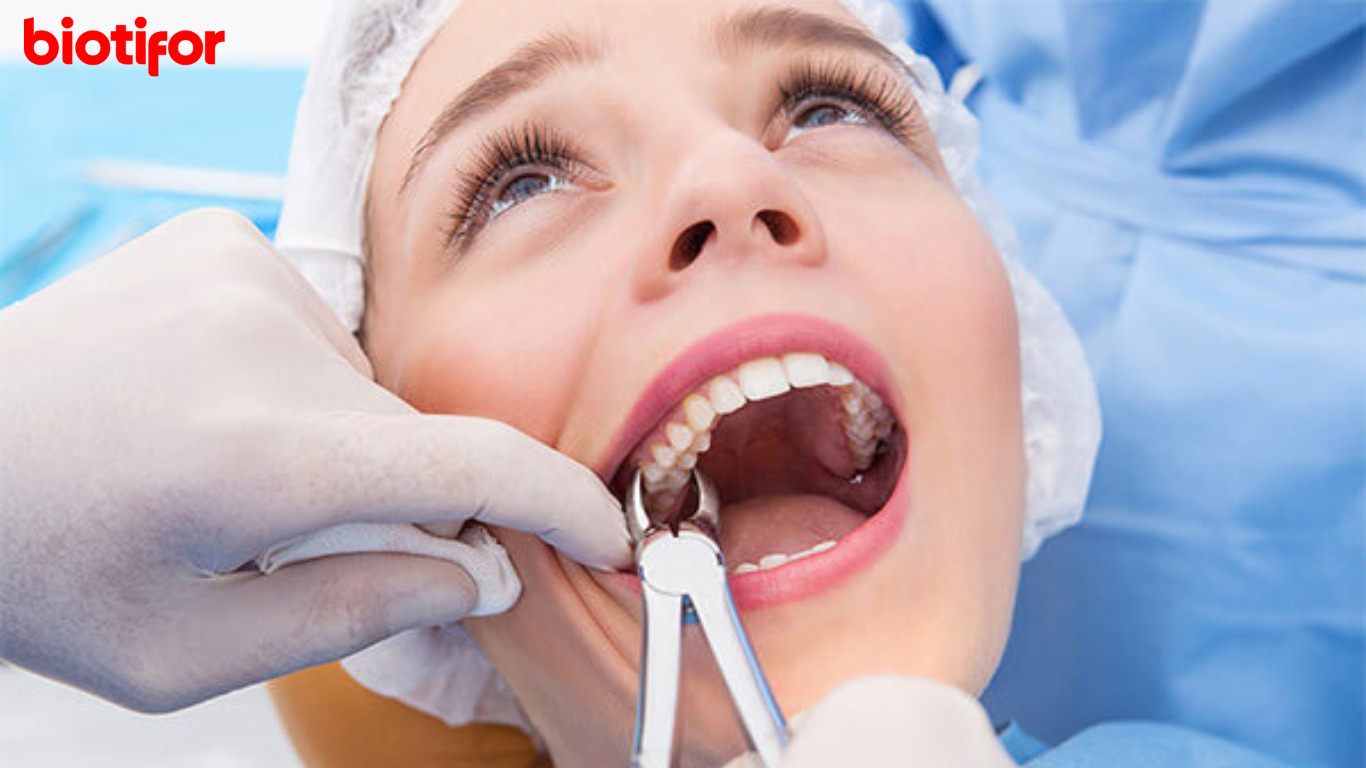 Ciri Infeksi Setelah Cabut Gigi: Tanda, Pencegahan, Pengobatan - Biotifor