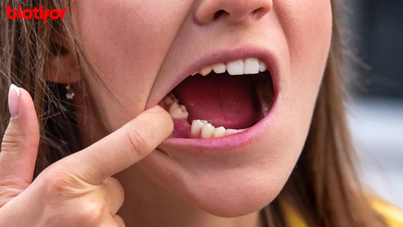 Ciri Infeksi Setelah Cabut Gigi: Tanda, Pencegahan, Pengobatan - Biotifor