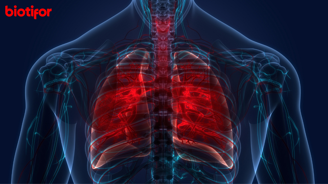 Gejala TBC: Kenali Gejala, Penyebab, dan Pengobatannya - Biotifor