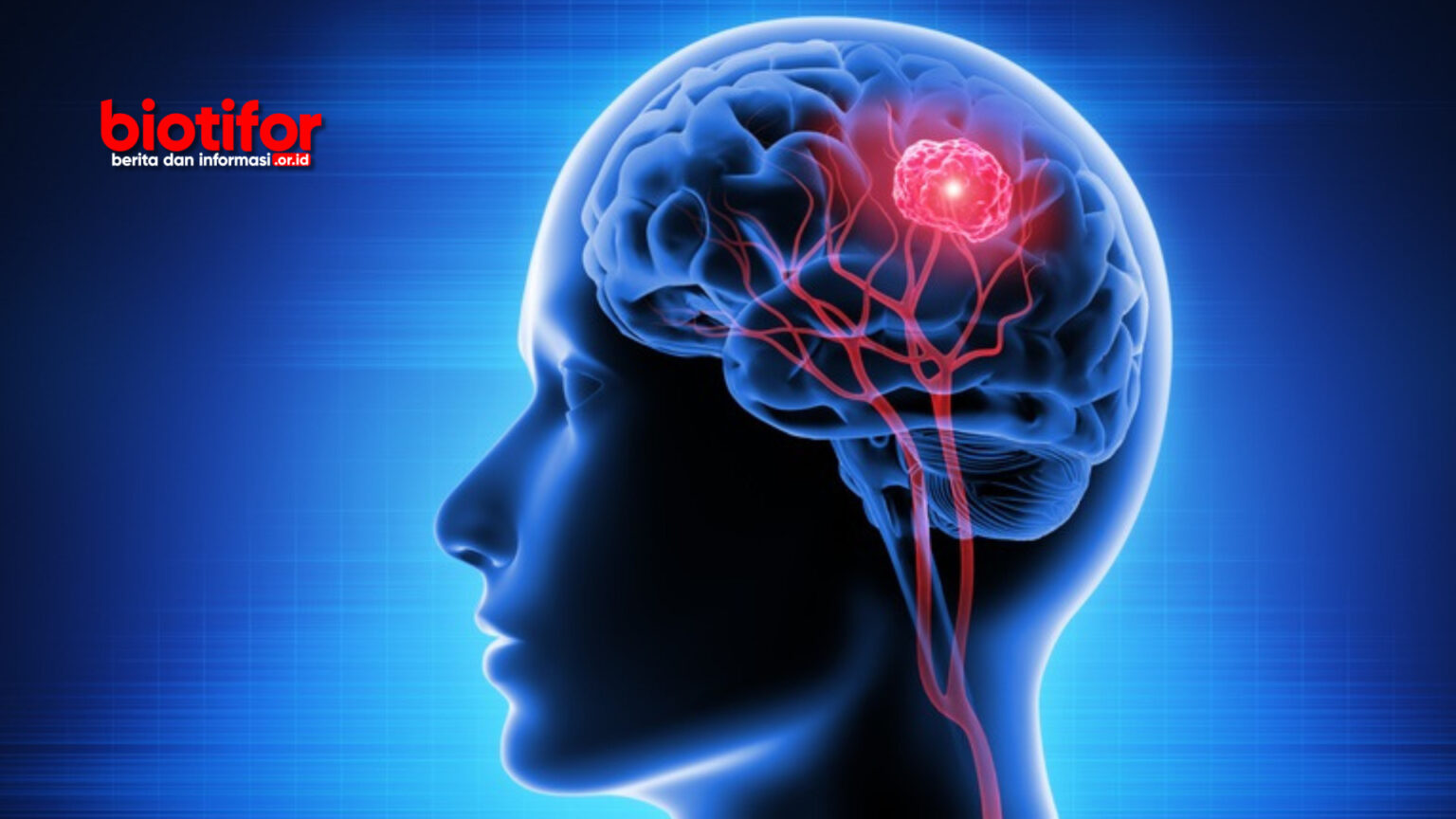 Penyebab Kanker Otak : Ancaman Yang Perlu Diwaspadai - Biotifor