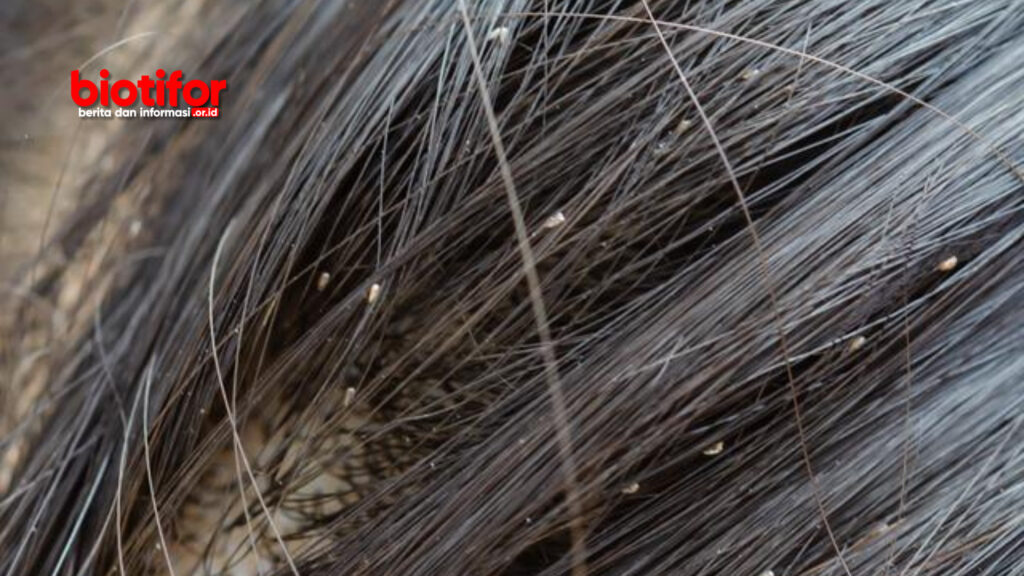 Cara menghilangkan telur kutu Dengan Mudah Dan Efektif